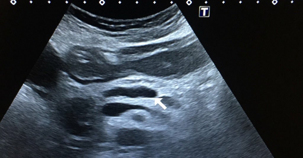 POCUS #1: un concepto entendido por pocos – INTERCONSULTA ON-LINE