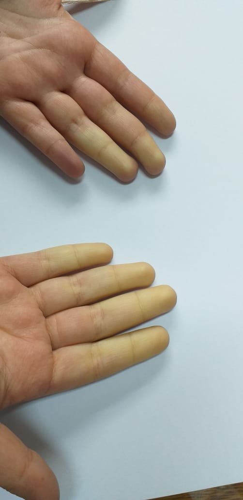 Multimedia en Medicina #12: fenómeno de Raynaud – INTERCONSULTA ON-LINE