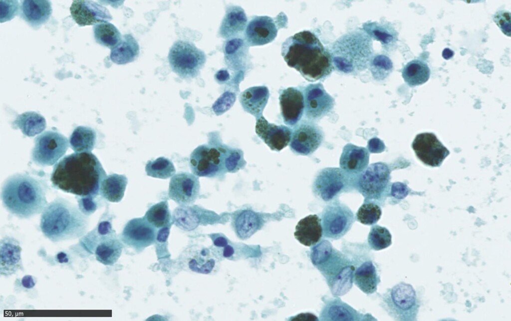 Caso Clínico #2: síndrome de impregnación en mujer de 62 años ...
