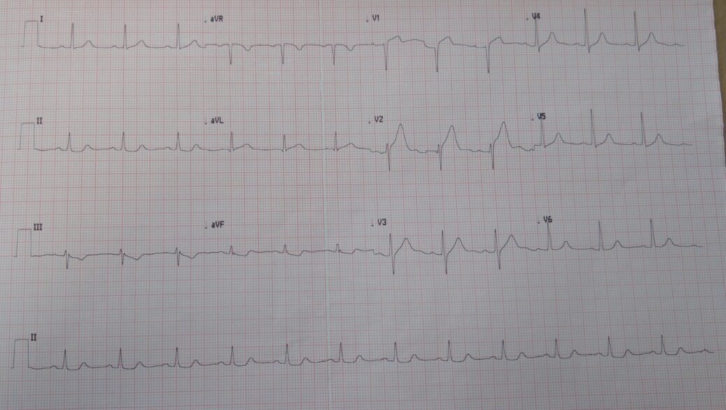 Caso Clínico #48: IAM con trombosis intra stent – INTERCONSULTA ON-LINE