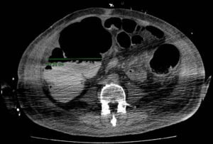Caso Clínico #56: pseudo-obstrucción colónica aguda – INTERCONSULTA ON-LINE