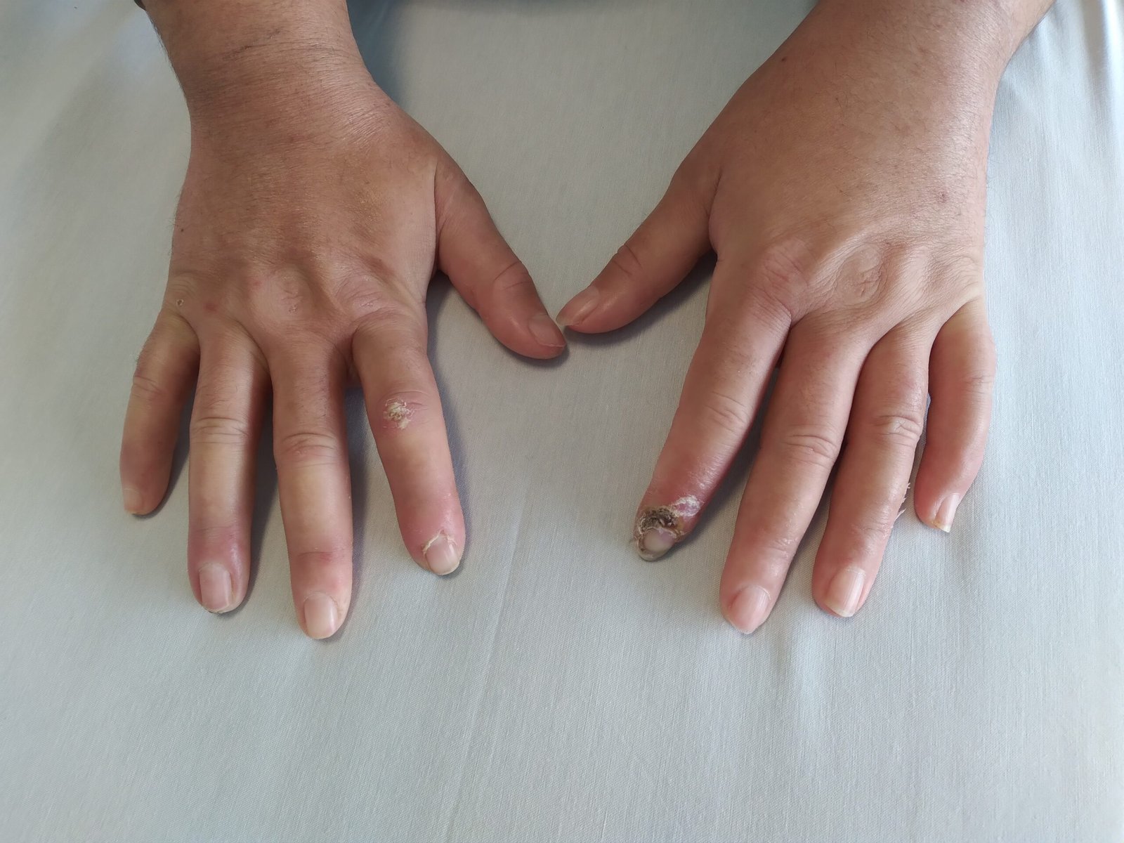 Multimedia en Medicina #38: esclerodactilia – INTERCONSULTA ON-LINE