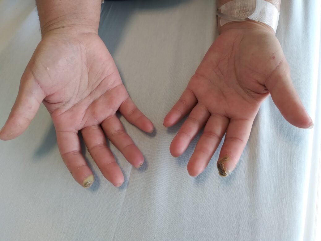 Multimedia en Medicina #38: esclerodactilia – INTERCONSULTA ON-LINE