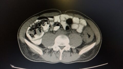 Comité de Tumores Virtual #4: carcinoma indiferenciado de colon ...