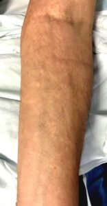 Multimedia en Medicina #50: signo del surco – INTERCONSULTA ON-LINE